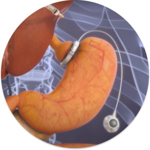 Magnetic Surgery® | Levita Magnetics